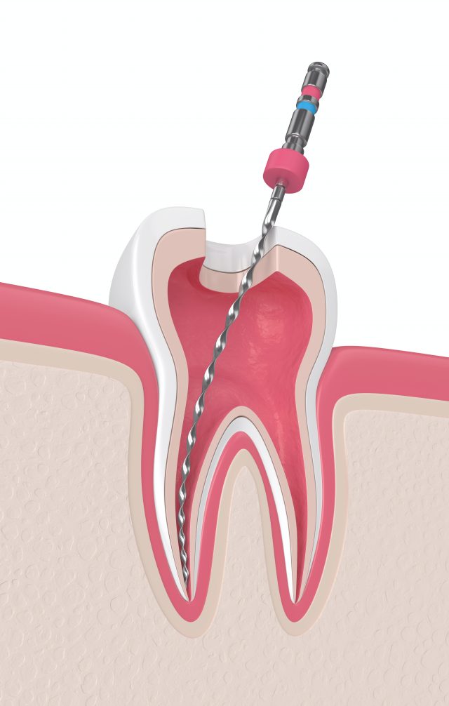 Corrective Dental Treatments - Namma Baby Dentist